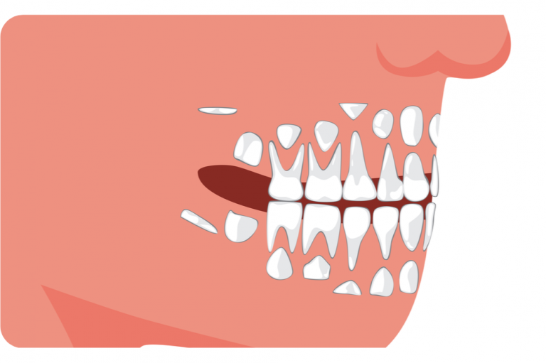 Baby teeth: the age they fall out, the sequence of losing them and some ...