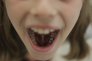 The Silver Tooth Kid Trend: What It Is and Why Kids Have Silver Crowns ...