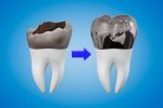 The Silver Tooth Kid Trend: What It Is and Why Kids Have Silver Crowns ...