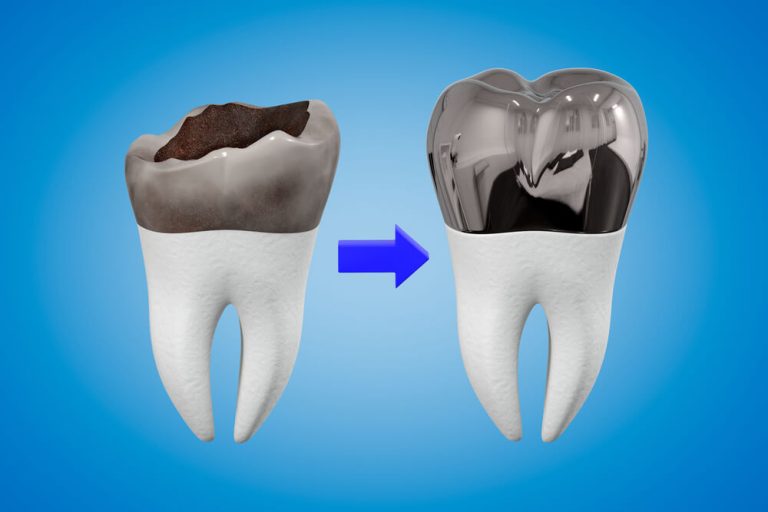 The Silver Tooth Kid Trend: What It Is and Why Kids Have Silver Crowns ...